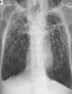 Engineered Stone Quartz Countertop Silicosis | Cancer Lawsuit